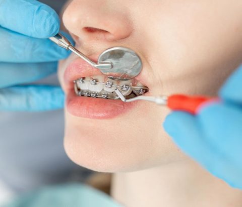 Orthodontics | Thornton Dental